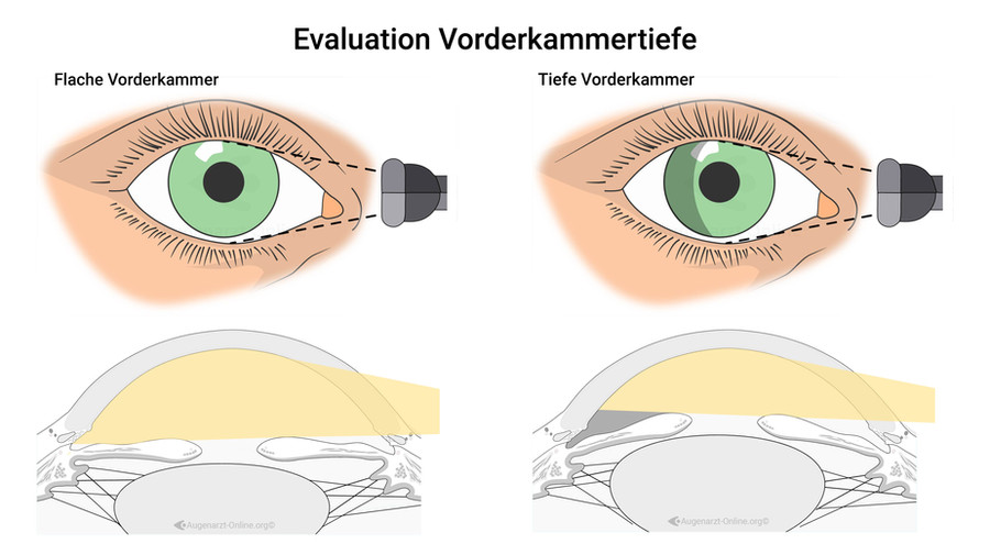 Beurteilung des Kammerwinkels | Lexikon der Augenheilkunde