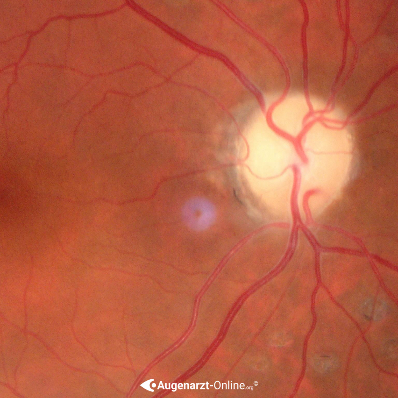 NAION | Atlas der Augenheilkunde