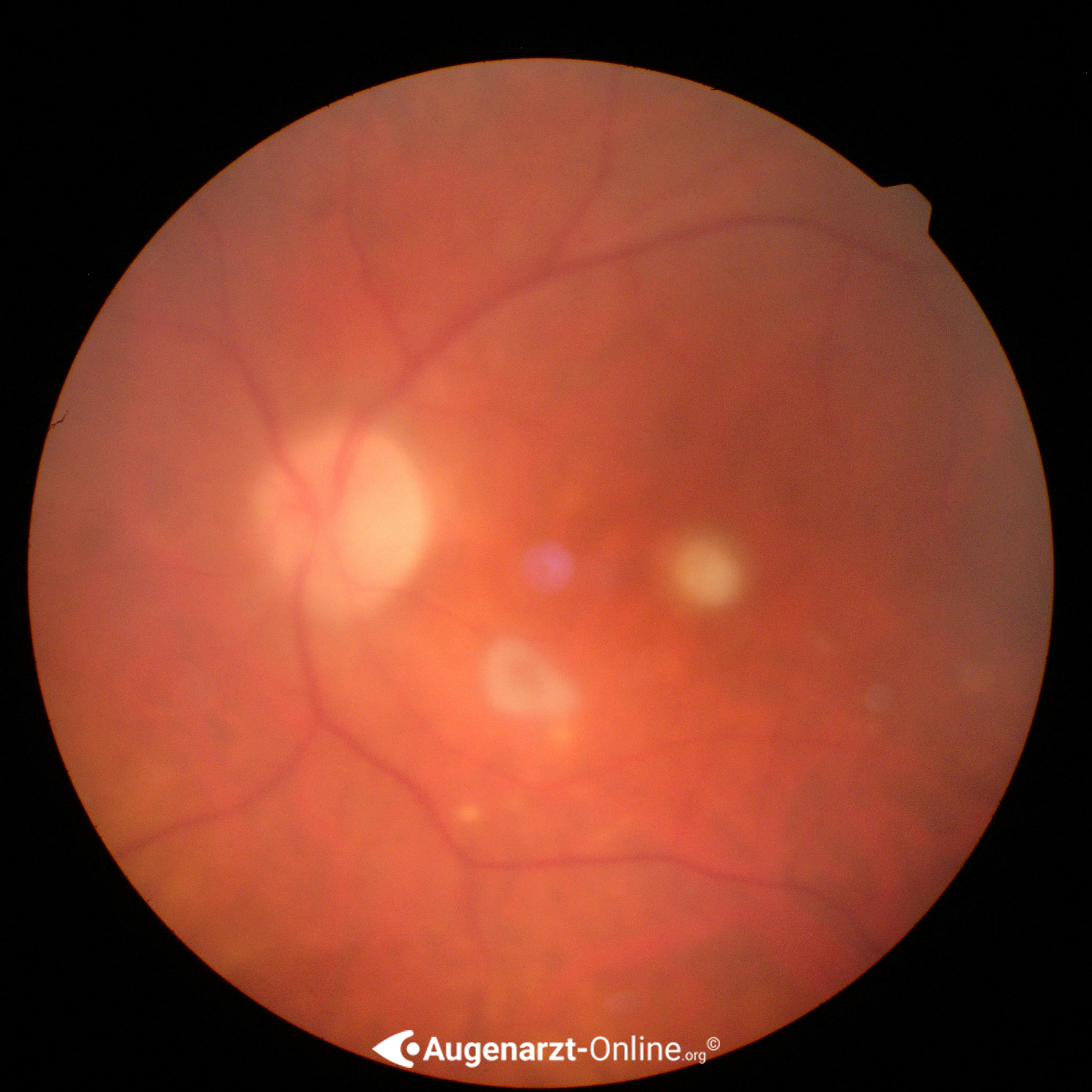 Candida Endophthalmitis