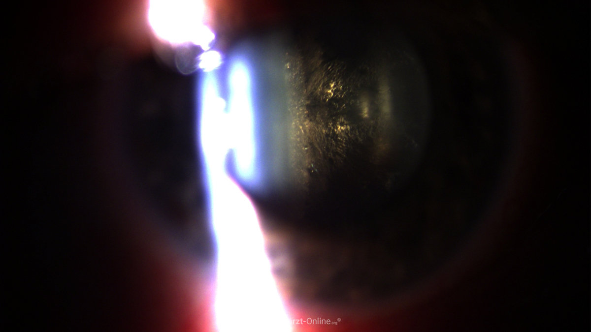 Gasfiederung der Linse nach C2F6-Gas | Atlas der Augenheilkunde