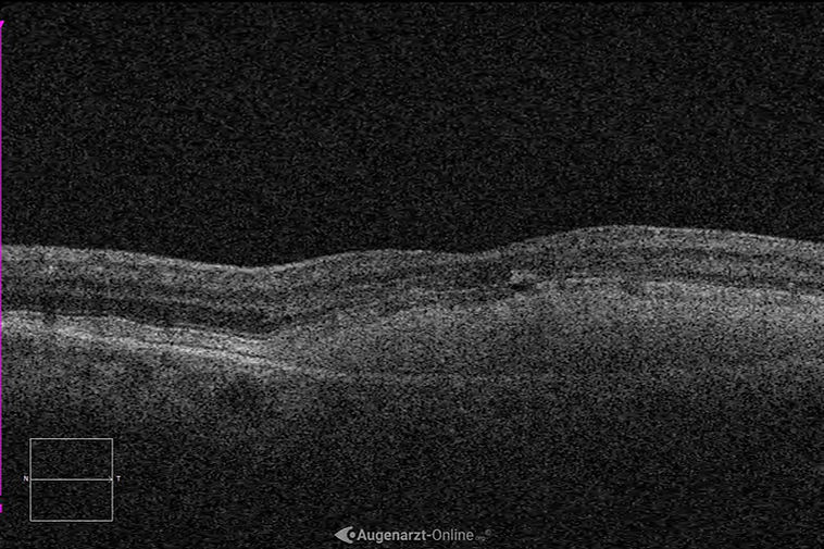 Polypoidale choroidale Vaskulopathie | Atlas der Augenheilkunde