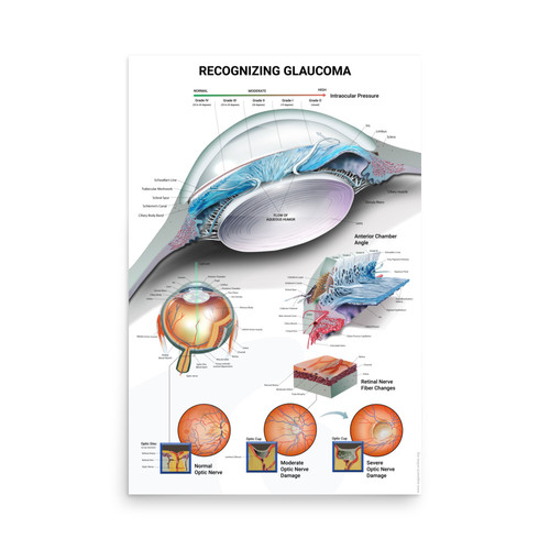 Recognizing Glaucoma - Poster | Augenarzt Online