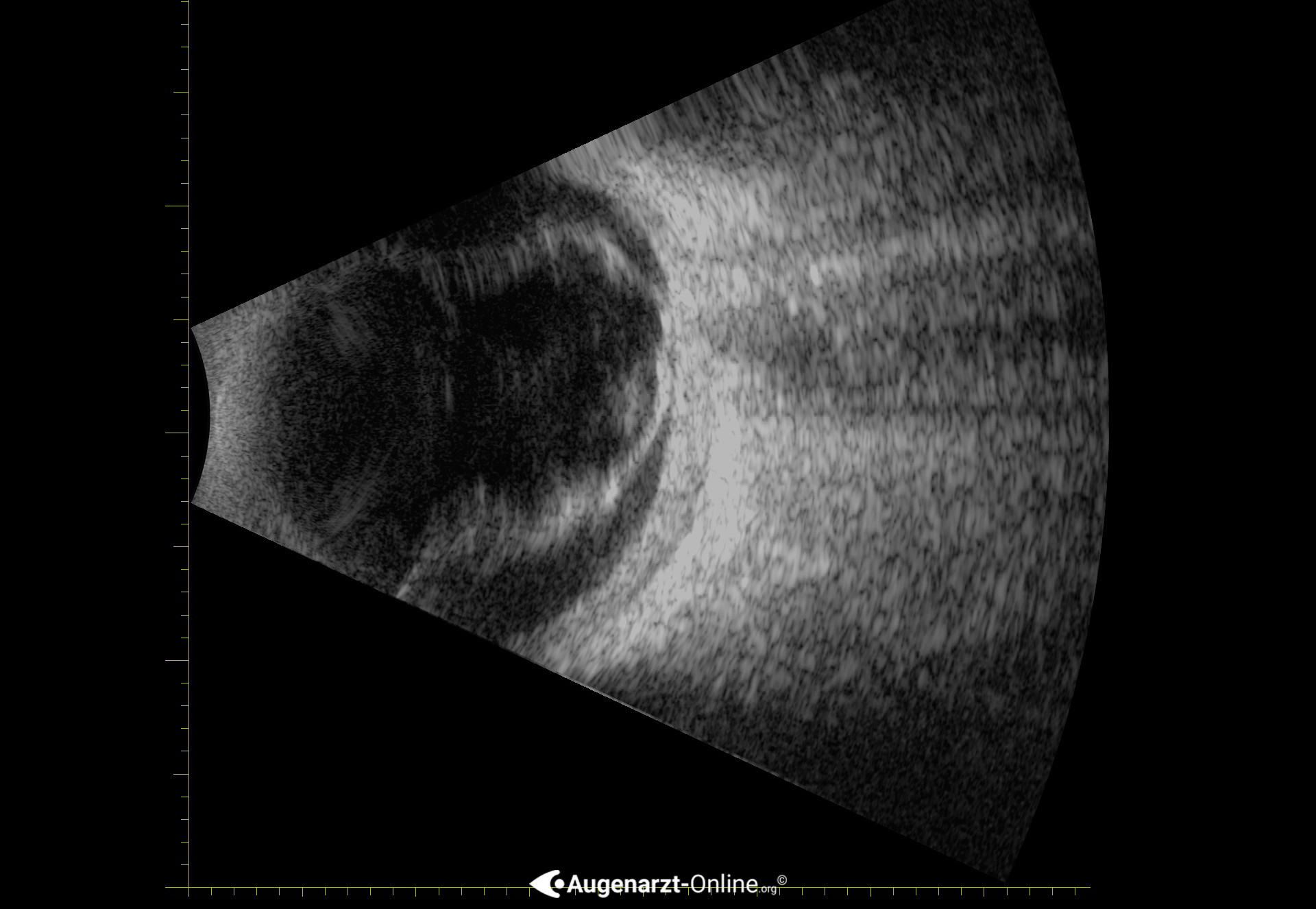 Netzhautablösung (Makula Off Ablatio retinae))