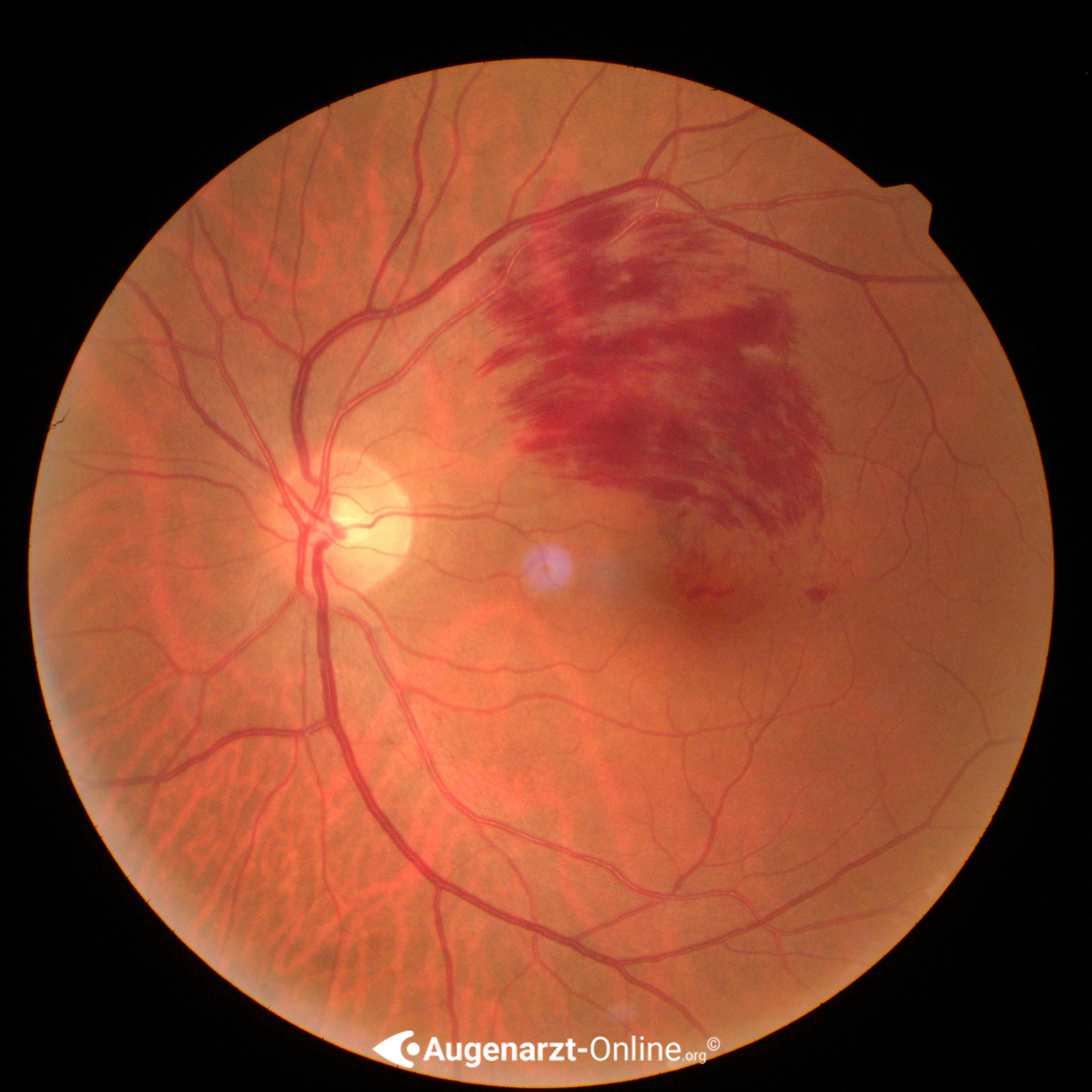 Venenastthrombose | Atlas der Augenheilkunde