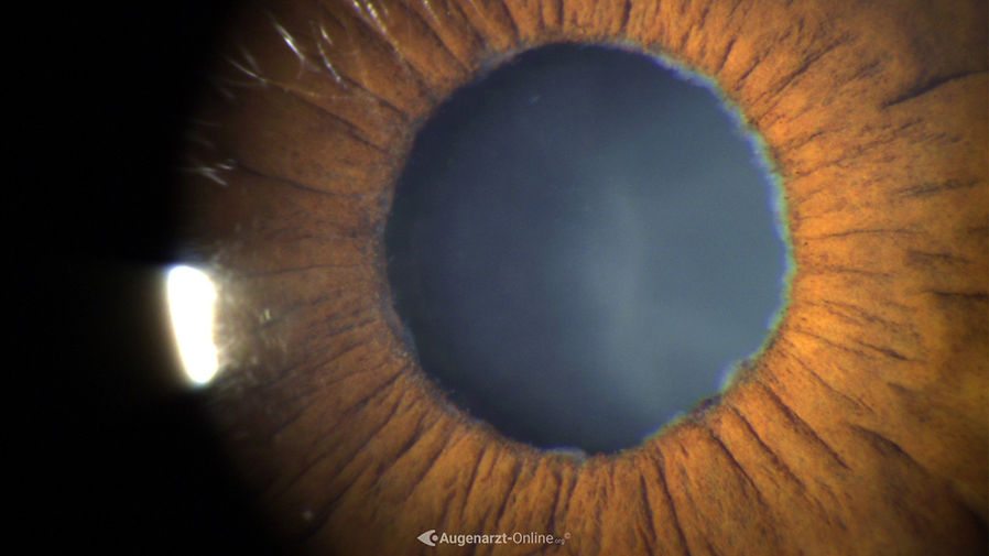 Pseudoexfollikationssyndrom | Atlas der Augenheilkunde