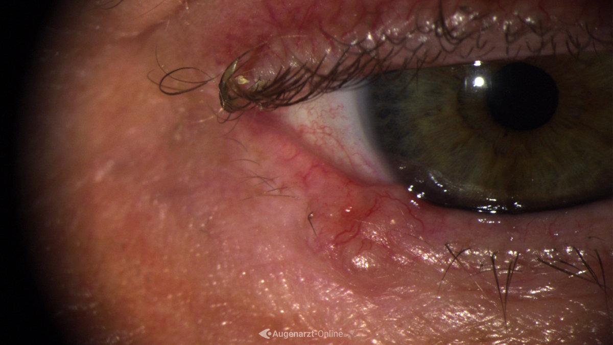 Krankheiten, Solides Basaliom, 61e80fce-56ff-4c9c-bbc1-873b775446ee