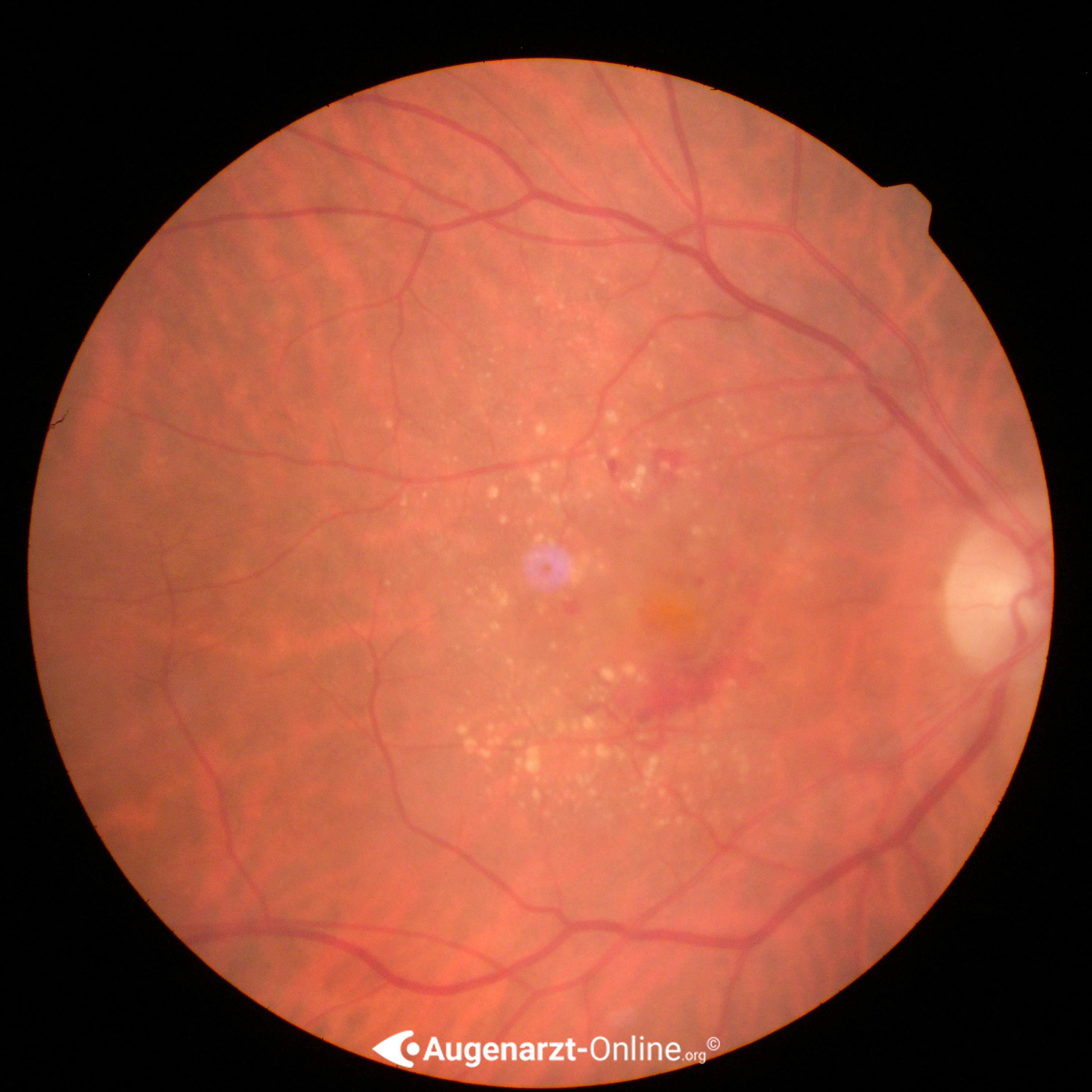 Exsudative AMD | Atlas der Augenheilkunde