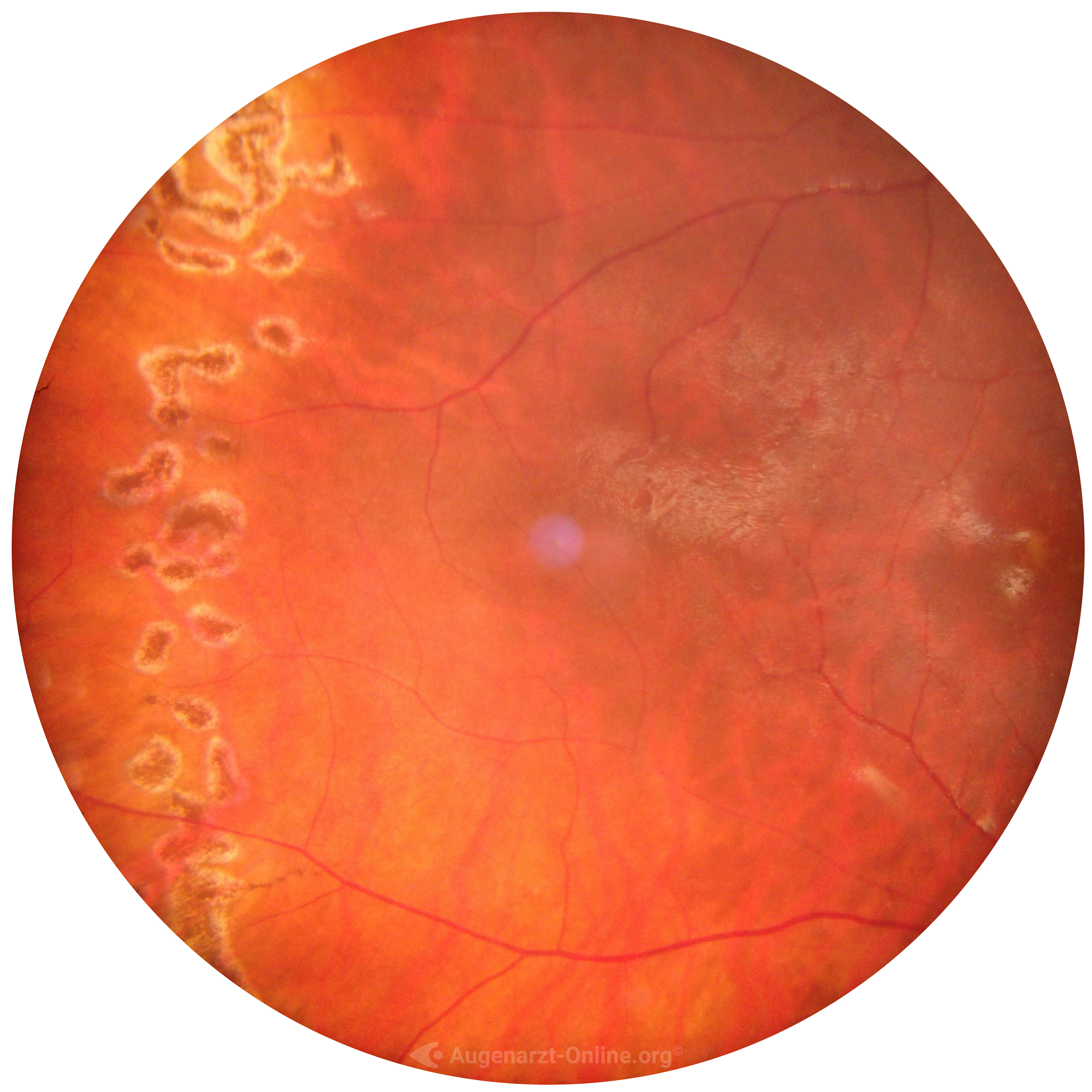 Laserkoagulation | Netzhaut | Fundus Trainer