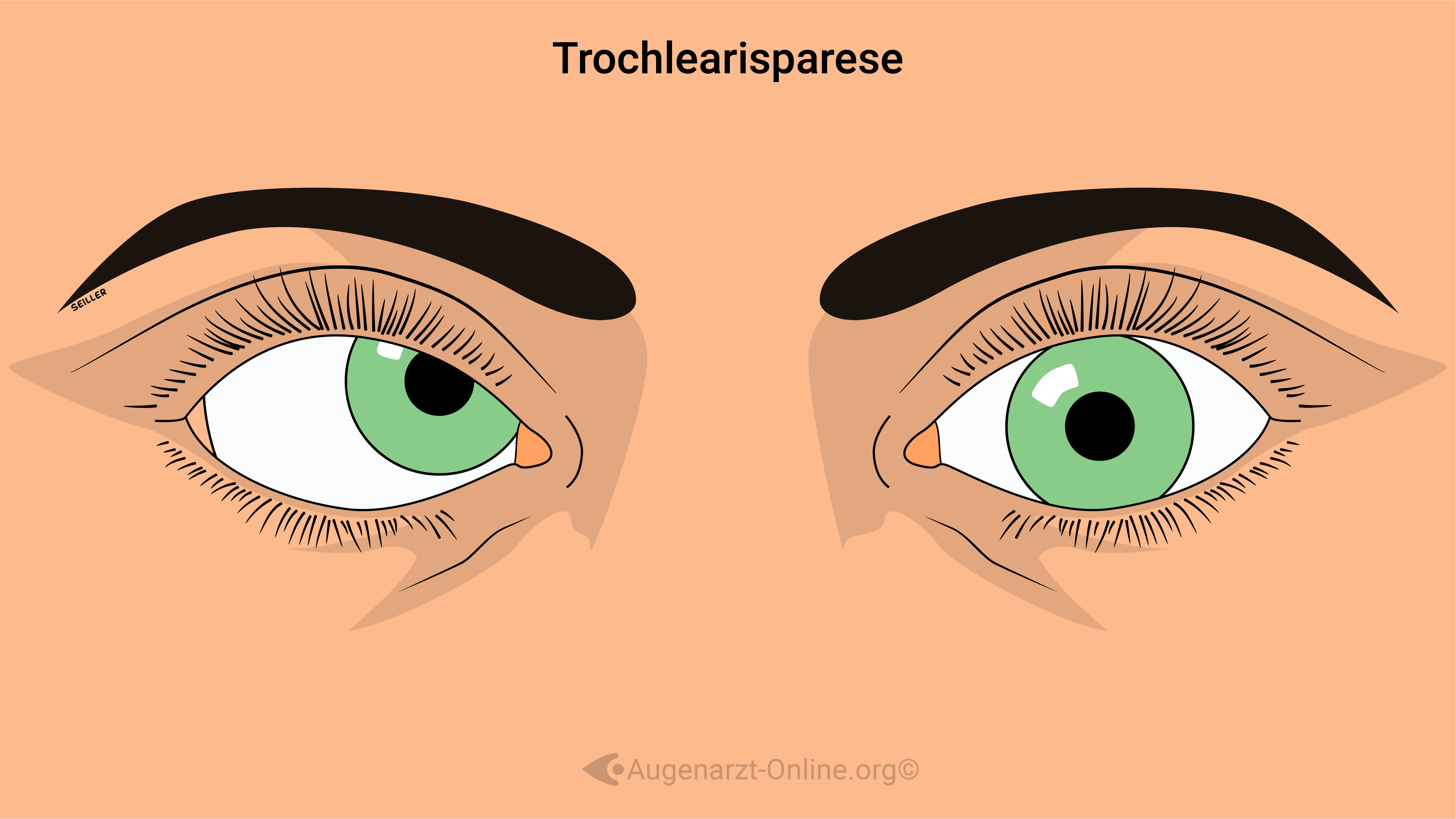 Trochlearisparese | Atlas der Augenheilkunde