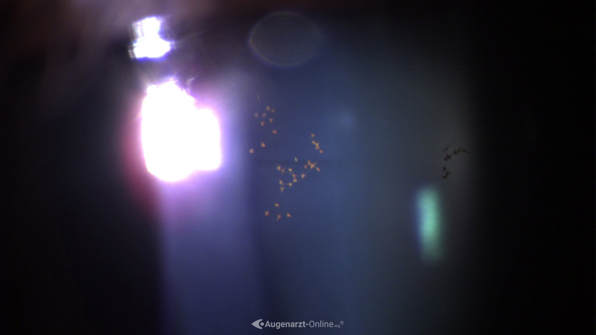 Epicapsular Stars | Atlas der Augenheilkunde