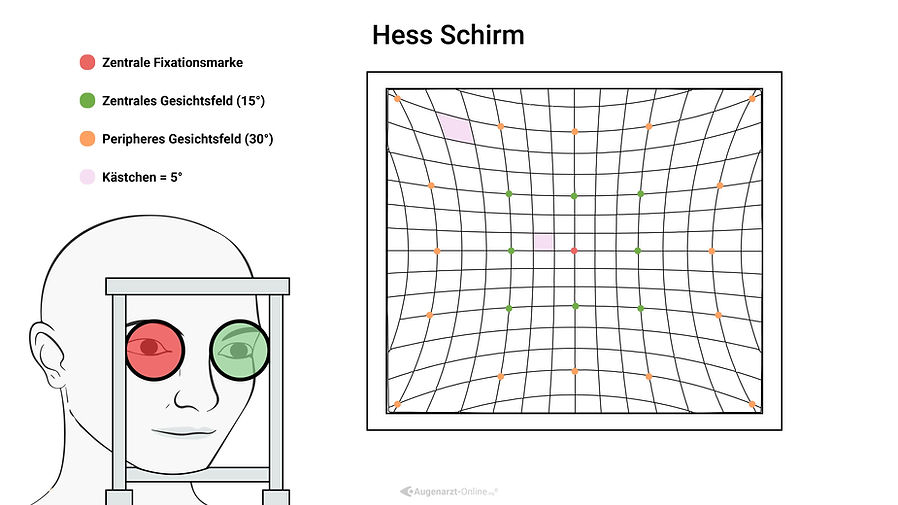 Hess Diagramm | Lexikon der Augenheilkunde