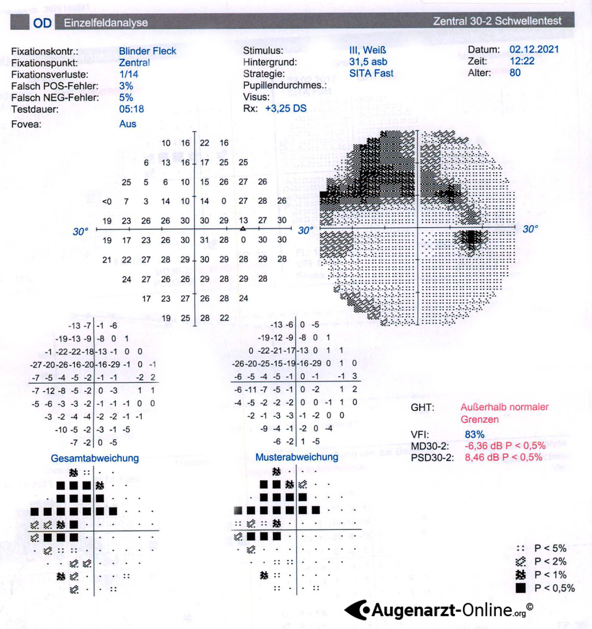 Glaukom | Atlas der Augenheilkunde