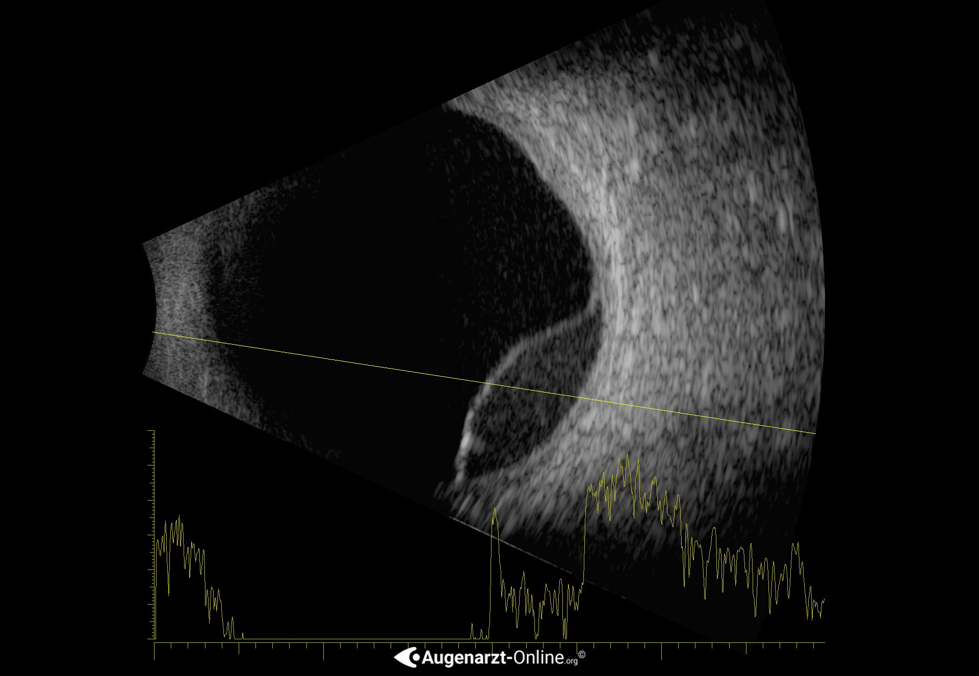 Ablatio retinae | Atlas der Augenheilkunde