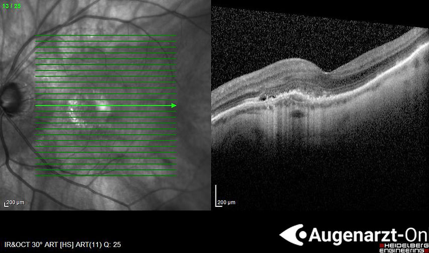 Trockene AMD | Atlas der Augenheilkunde