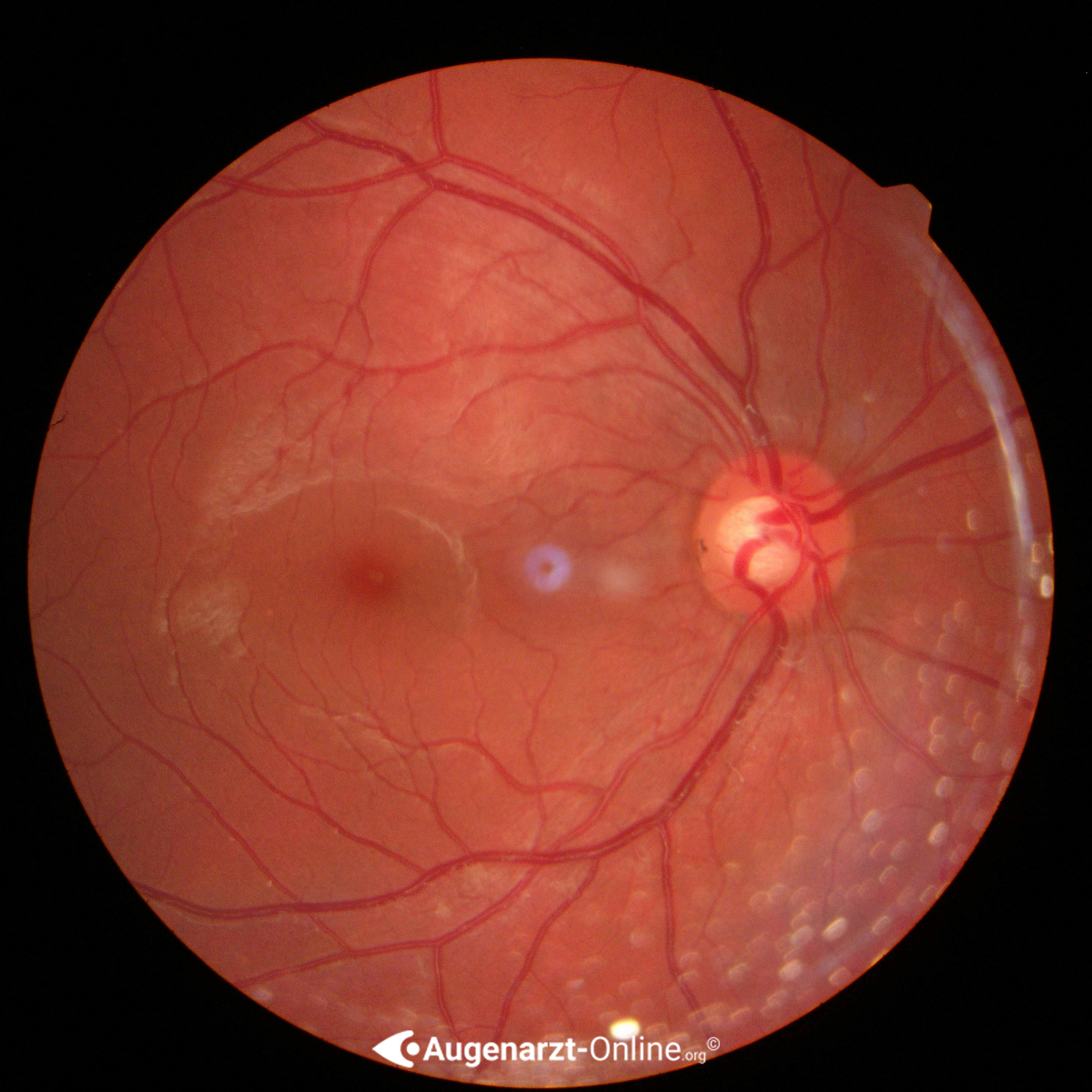 Tiefe Papillenexkavation | Atlas der Augenheilkunde