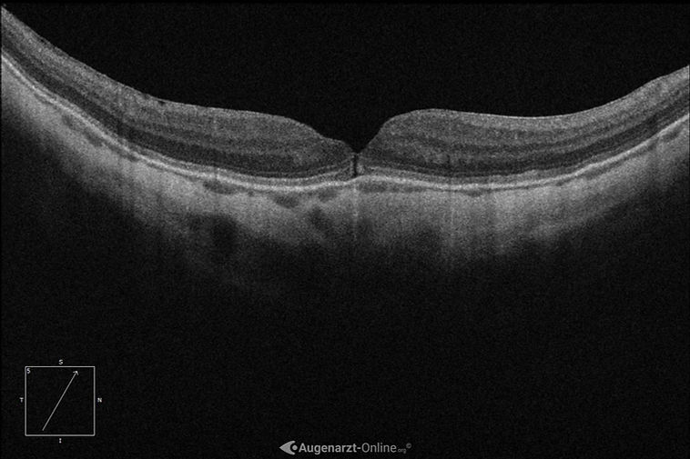 Fundus Myopicus | Atlas der Augenheilkunde