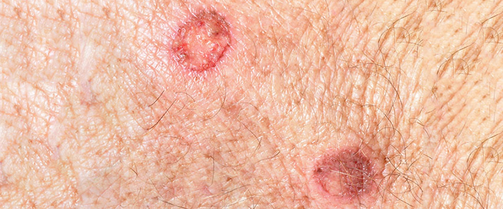 Queratose Actínica, O QUE É?