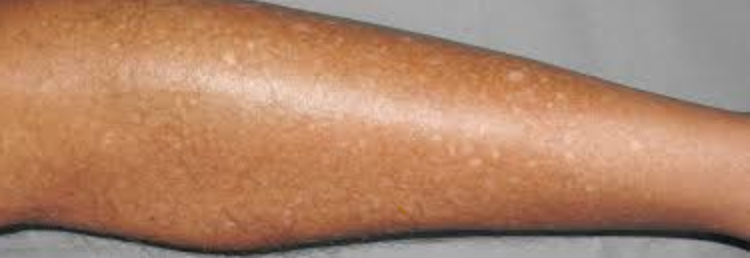 Leucodermia Gutata - (sarda branca) O QUE É?