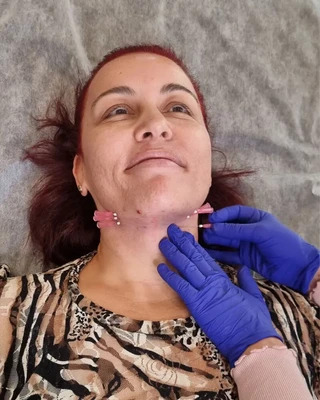 PDO Threads Face & Neck Lift | Skinoza Clinic London