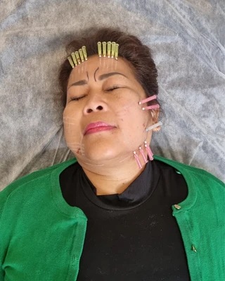 PDO Threads Face & Neck Lift | Skinoza Clinic London