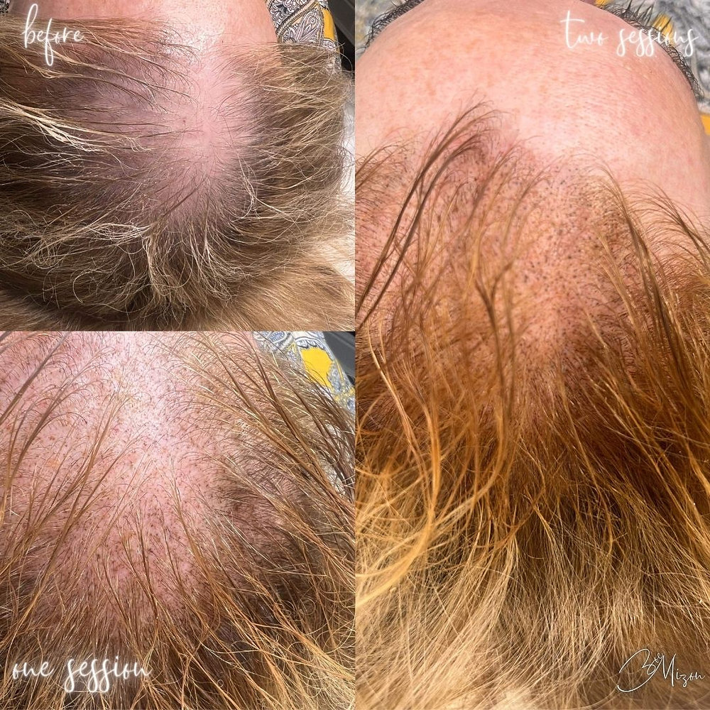scalp micro pigmentation