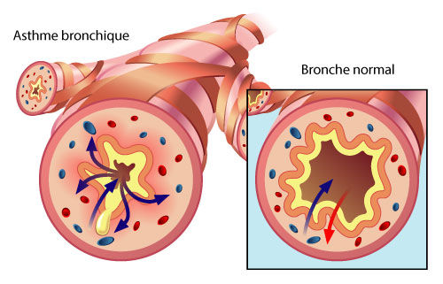 Les maladies chroniques