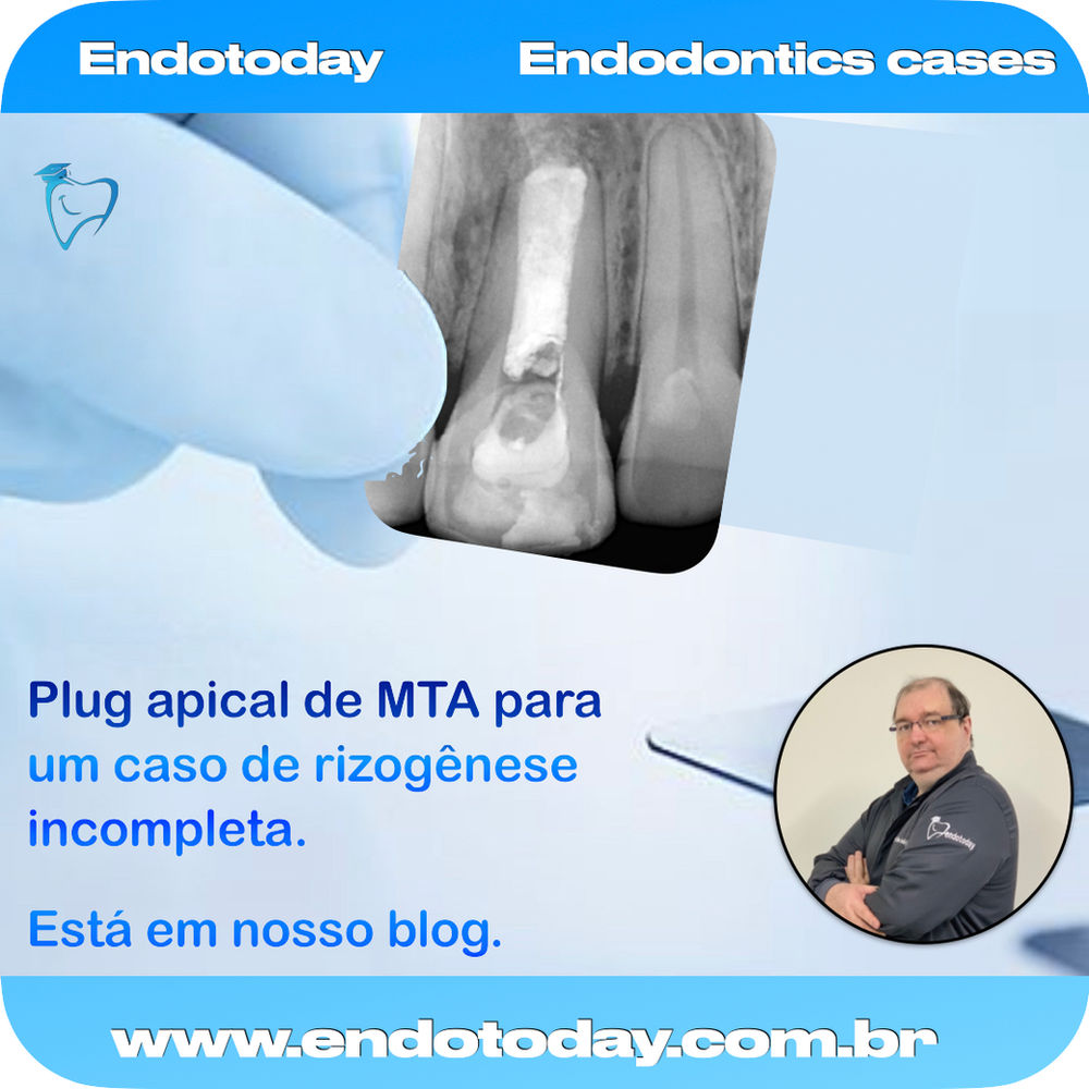 Plug Apical com MTA.