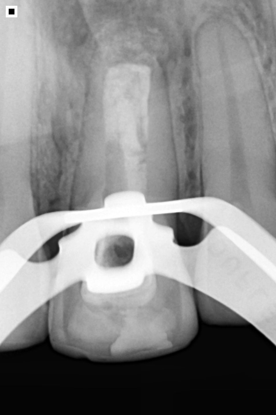 Plug Apical com MTA.