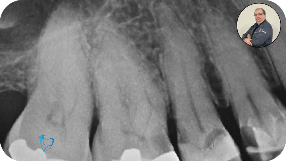 Sistema BioRace, pioneiro na ampliação apical biológica.