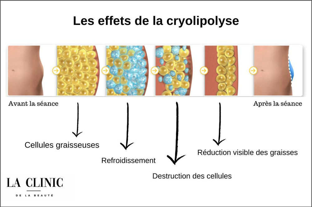 Séance Cryolipolyse à Avignon | La Clinic de la beauté