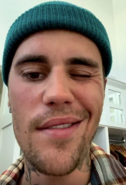 JUSTIN BIEBER'S FACE IS HALF PARALYZED!!! VAX??