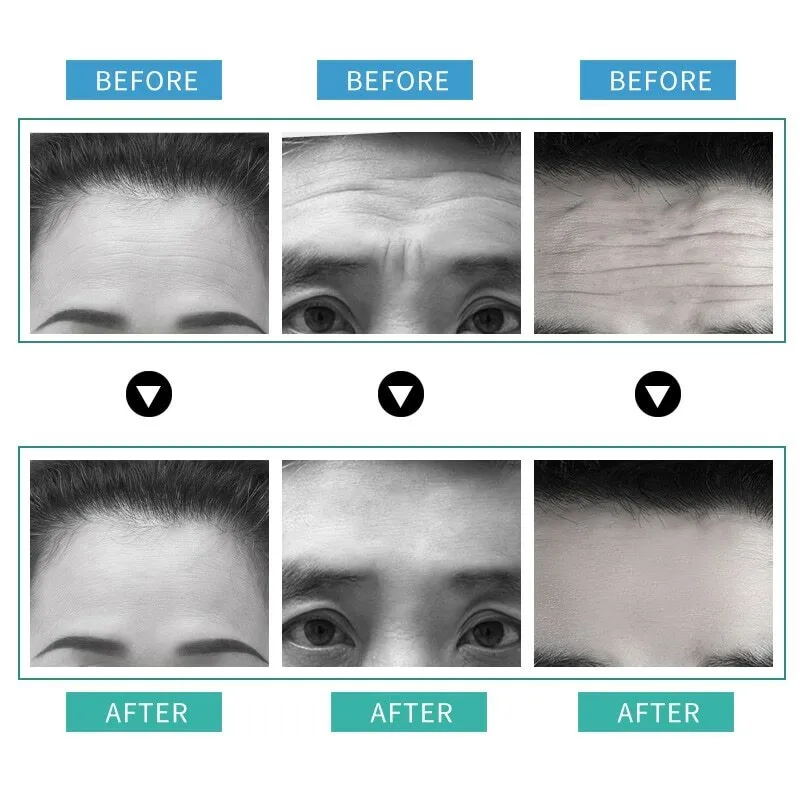 Anti-Wrinkle Sticker Pad Skin Lift Up Tape Frown Removal Facial Line ...