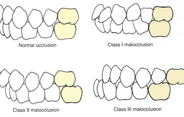 Do you know what occlusion class you have? | Gentle Care Dentistry ... Do you know what occlusion class you have? | Gentle Care Dentistry ...