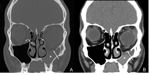 TC SENOS PARANASALES CON CONTRASTE | misitio