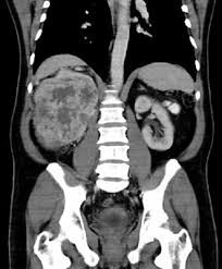 TC UROTAC PROTOCOLO PARA LITIASIS (TC SIMPLE) | misitio