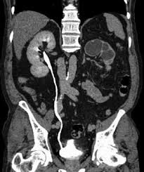TC UROTAC SIMPLE ABDOMEN COMPLETO | misitio