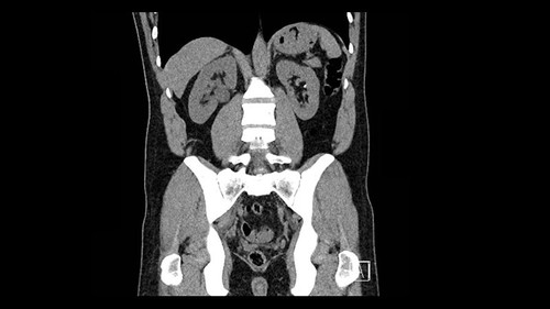 TC UROTAC CON CONTRASTE ABDOMEN COMPLETO | misitio