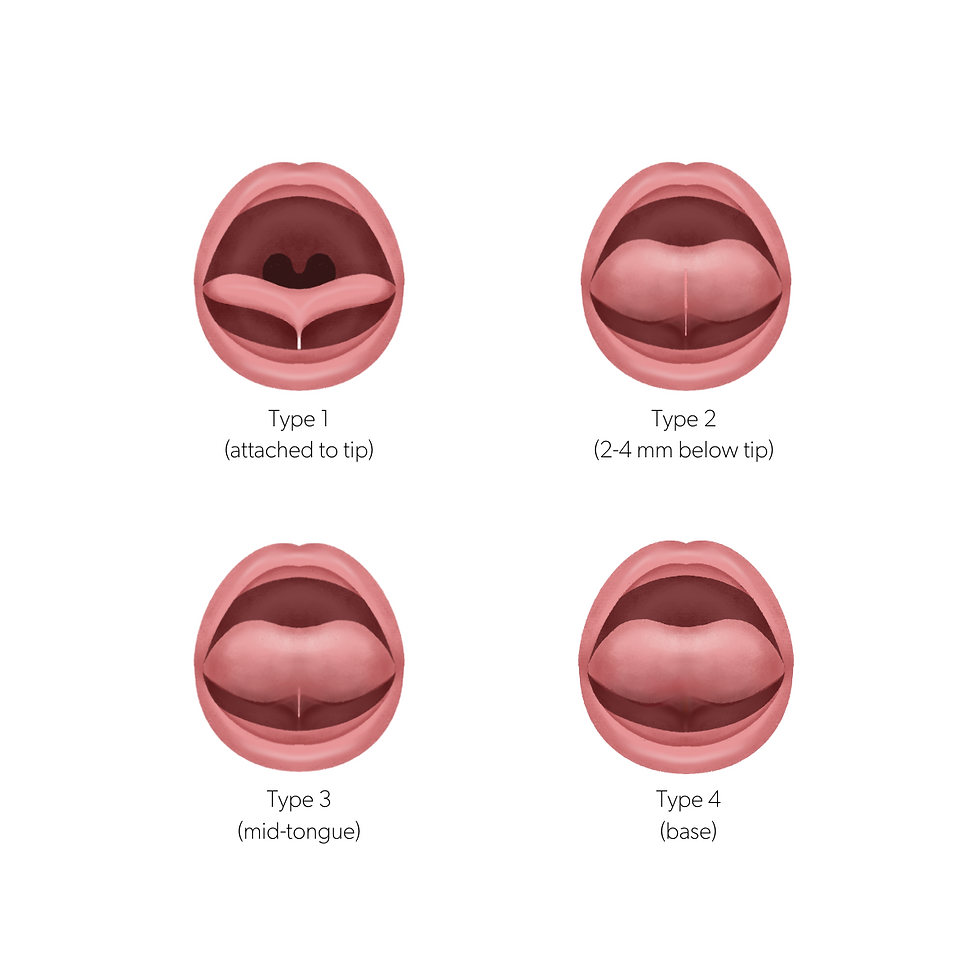 Understanding Tongue-Tie (Ankyloglossia)