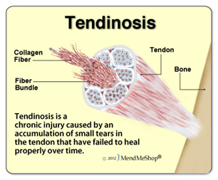Why the Difference Between Tendinitis and Tendinosis Matters