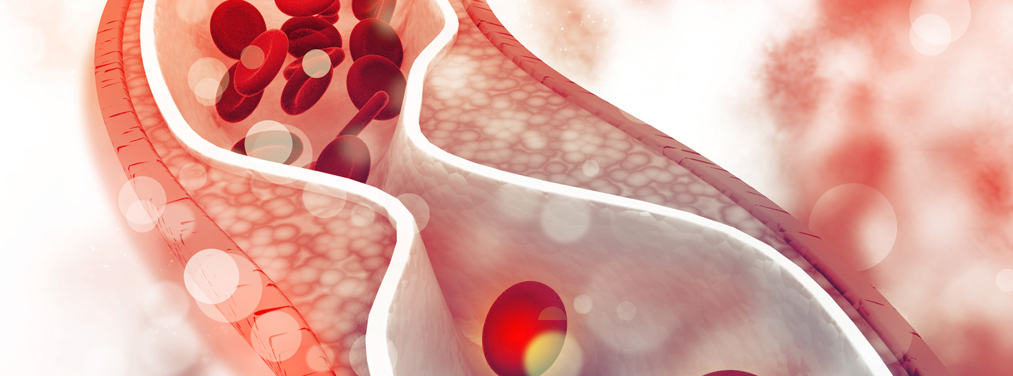 Ceretrieve | Complete Clot Trap | Israel