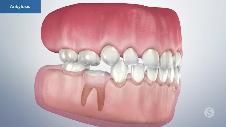 Ankylosed tooth - Dental Medicine