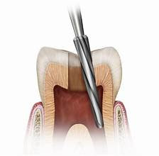 Tungsten Carbide FG152XL - ENDO Z type | MagnifiDENT