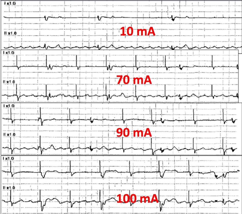 Transcutaneous Pacing: "Put It Up To Eleven!"