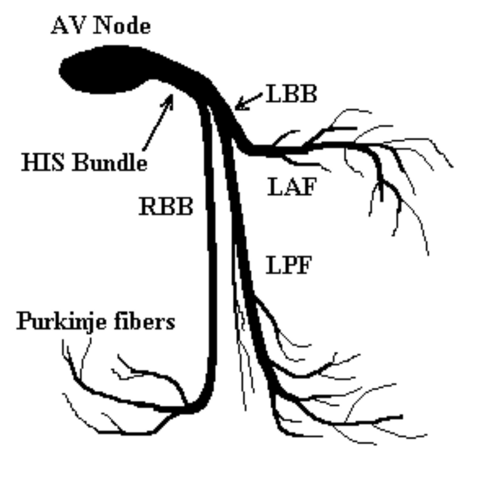 Left Anterior Fascicular Block (LAFB)