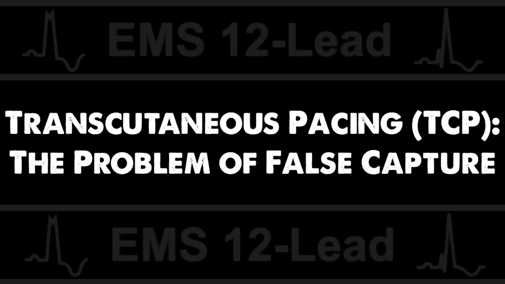 Transcutaneous Pacing (TCP): The Problem of False Capture