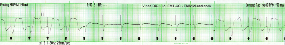 Transcutaneous Pacing Success!!! (Part 2)