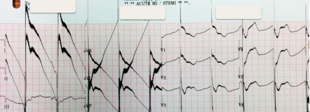 Transcutaneous Pacing: "Put It Up To Eleven!"