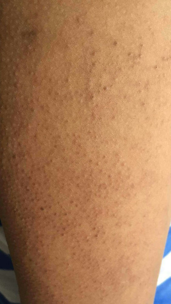 Keratosis Pilaris