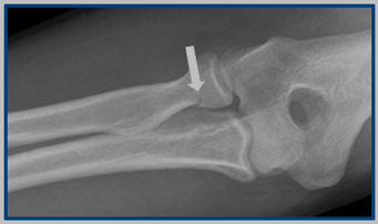 Radial Head/Neck Fracture | Bayside Hand Therapy