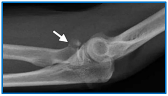 Radial Head/Neck Fracture | Bayside Hand Therapy
